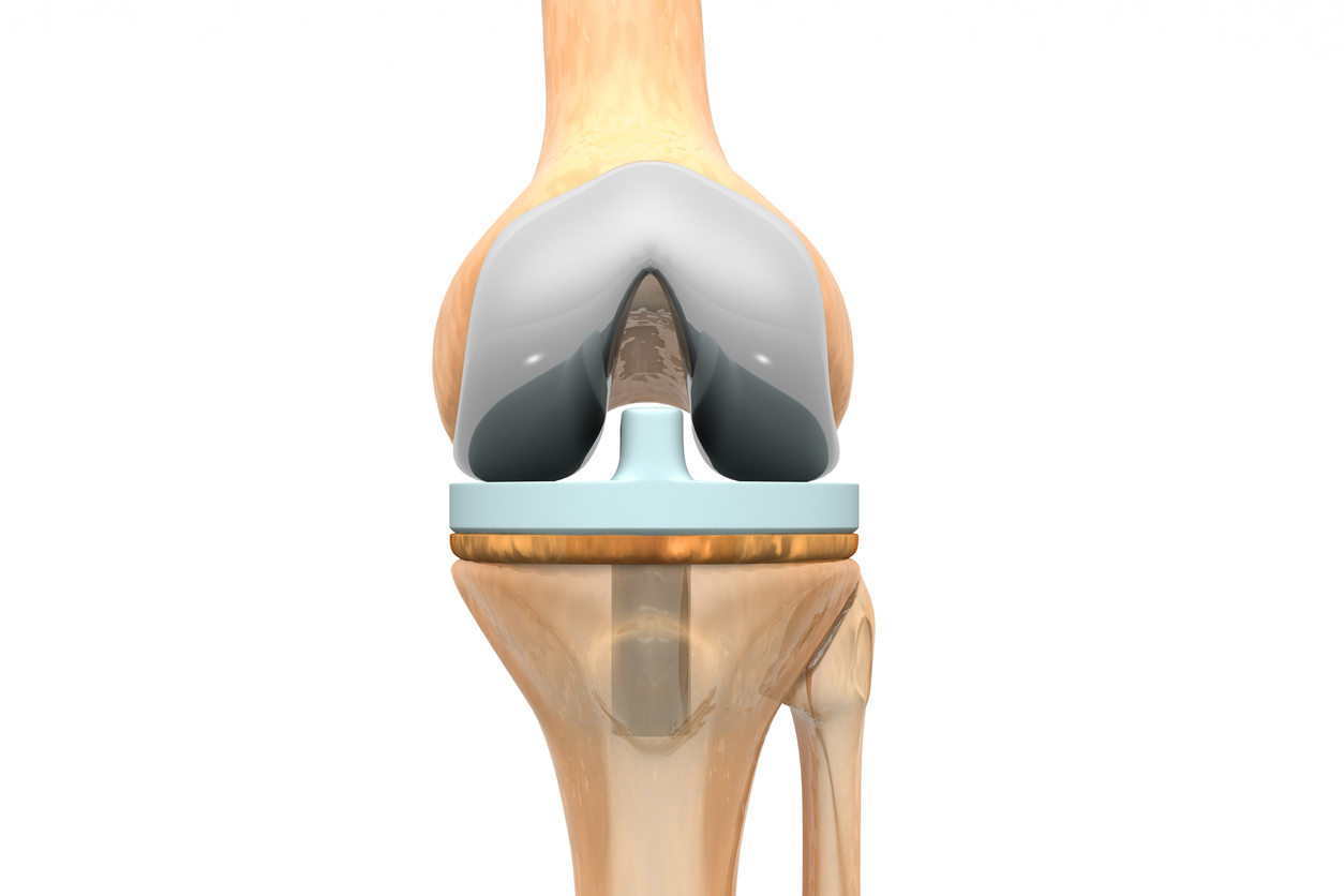 Joint Replacement Class – Ambulatory Surgery